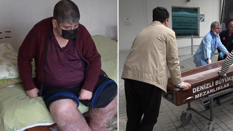 Fil Hastalığı Haberleri - Son Dakika Fil Hastalığı Hakkında Güncel ...