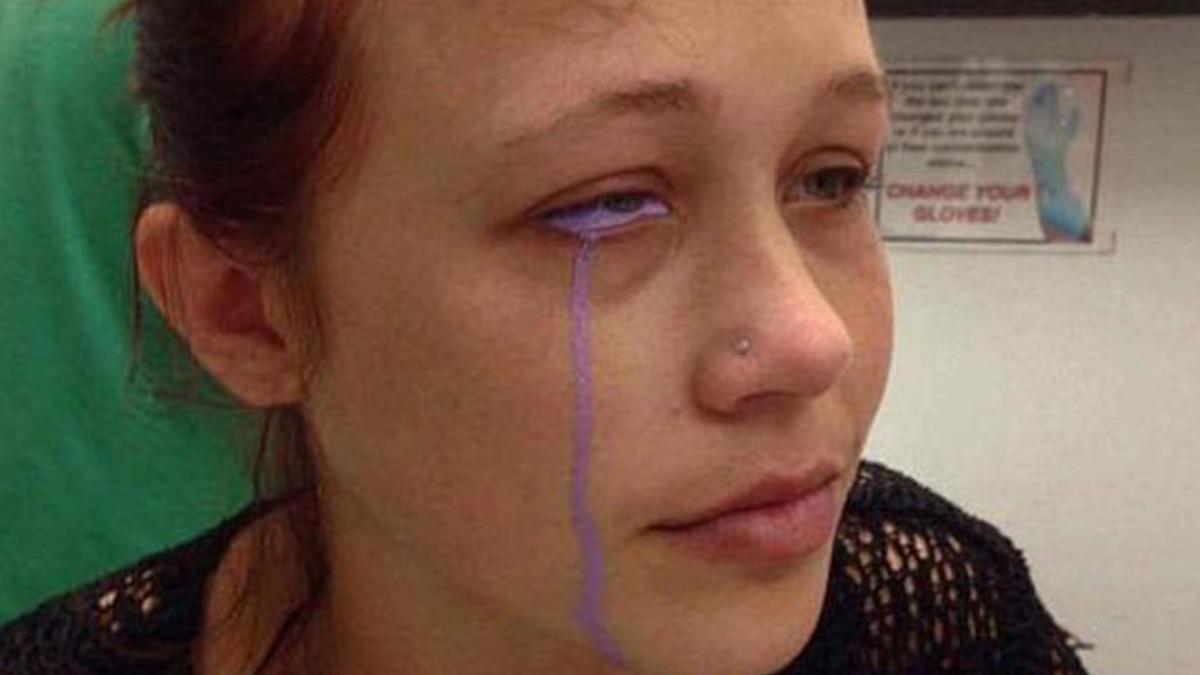 24 yaşındaki model Catt Gallinger gözünü kaybedebilir - Son Dakika ...