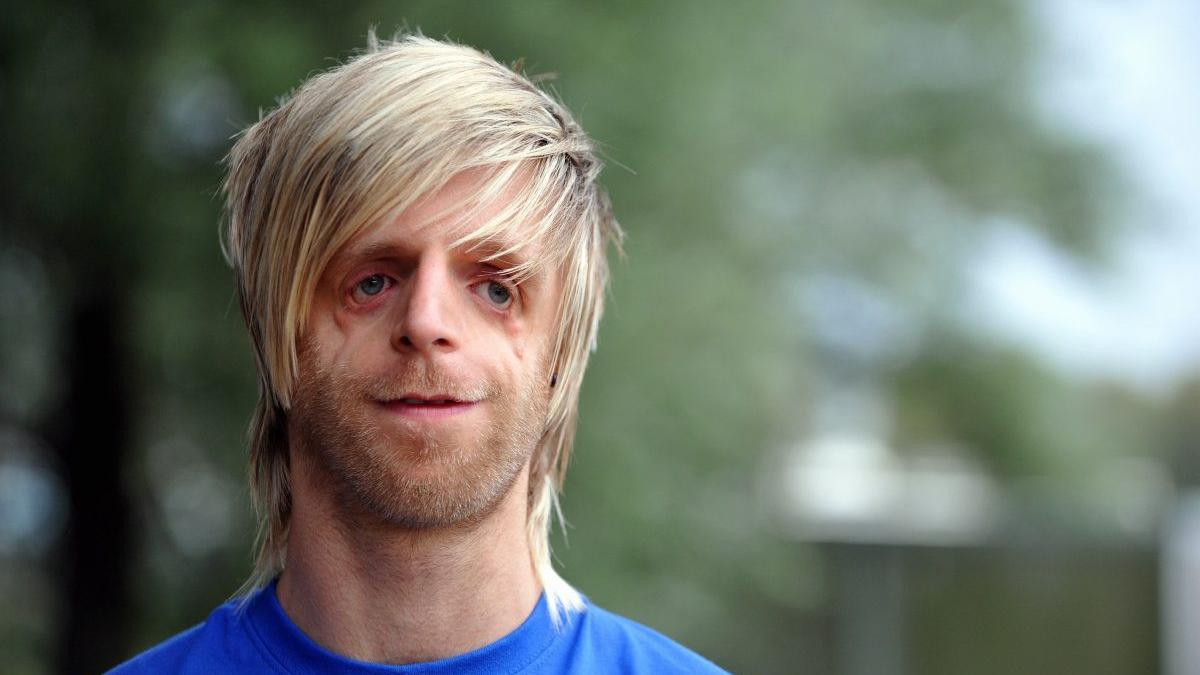 Treacher Collins Sendromu (TCS) nedir?