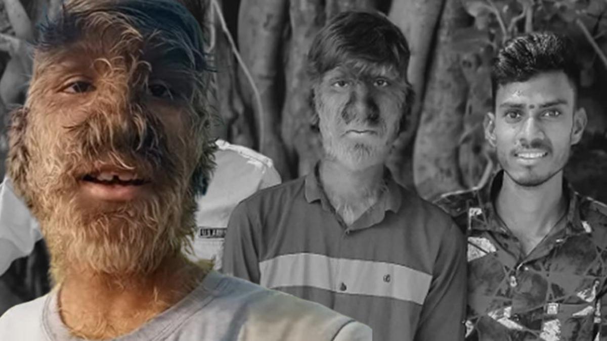 Dünya üstünde sadece 50 kişide olan 'kurt adam' sendromu ile doğdu! 'İnsanlar sokakta üzerime ...